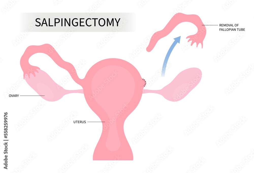 Anatomy uterus pain surgical biopsy hormone tube cancer tumor birth ...