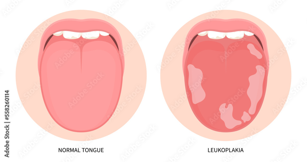 White fungal inflamed in mouth cancer ulcer swelling oral pain angular ...