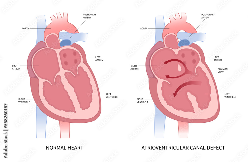 Poster Heart and atrioventricular canal defect with septum Endocarditis ...