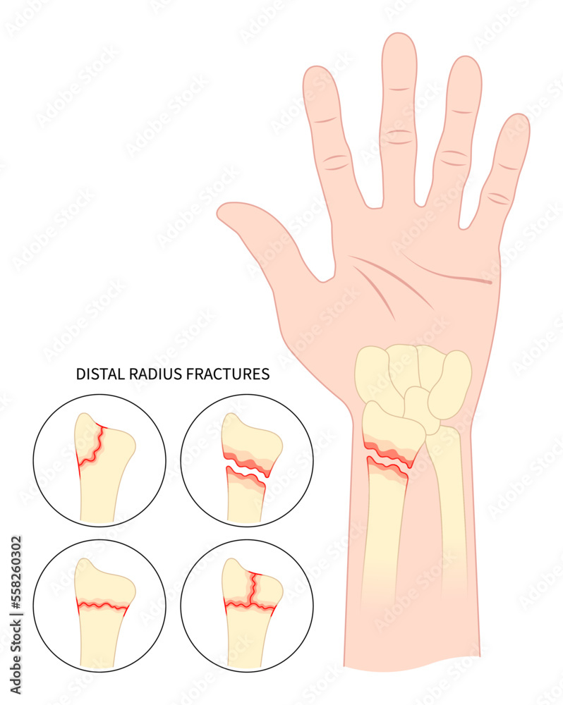Póster Painful hand break anatomy radial dislocated avascular necrosis ...