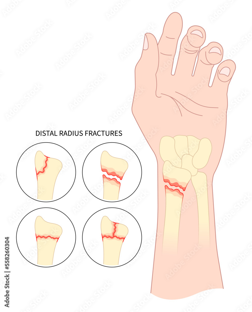 Fall onto an outstretched hand break painful anatomy radial dislocated ...
