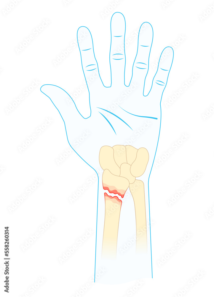 Avascular necrosis hand displacement break painful radial dislocated ...