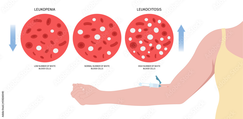 Low and high white Blood Cell Count for thrombocytosis of Basophilia ...
