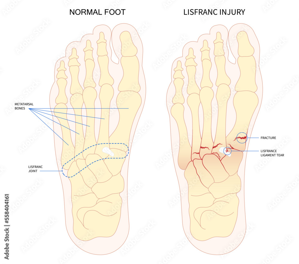 Heel toes bone foot trauma painful displaced and Chopart's five ...
