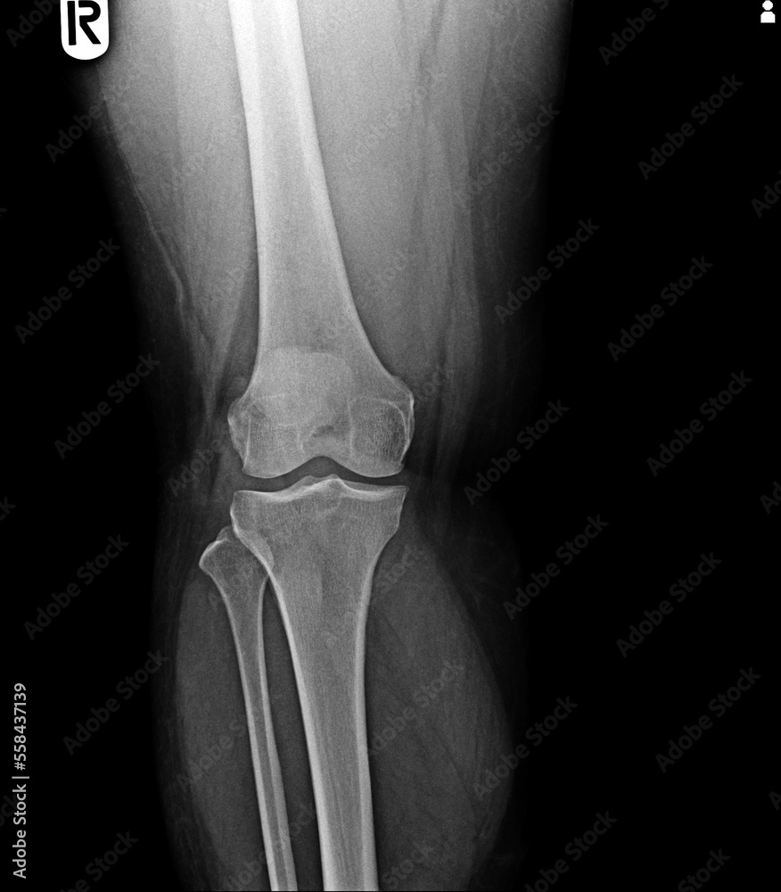 Film X Ray Ap Anterior Posterior Of Knee Show Narrow Joint Space Stock Illustration