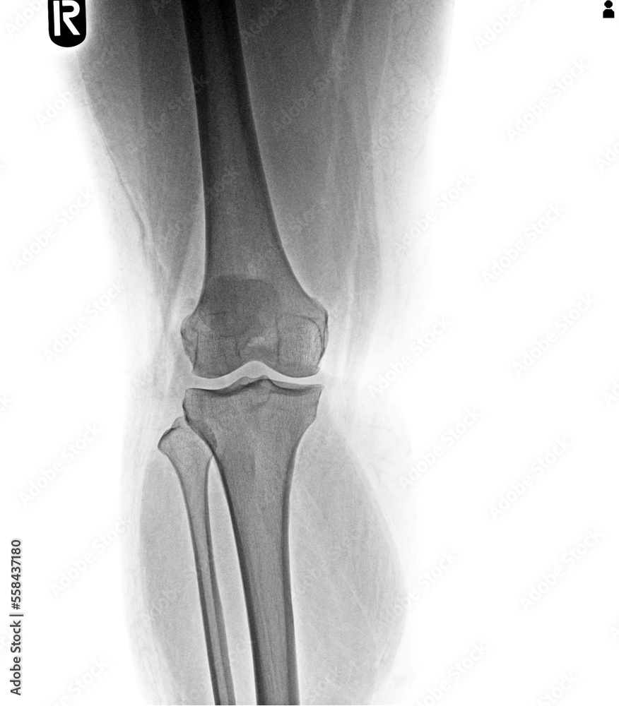film x-ray AP ( anterior - posterior ) of knee show narrow joint space ...
