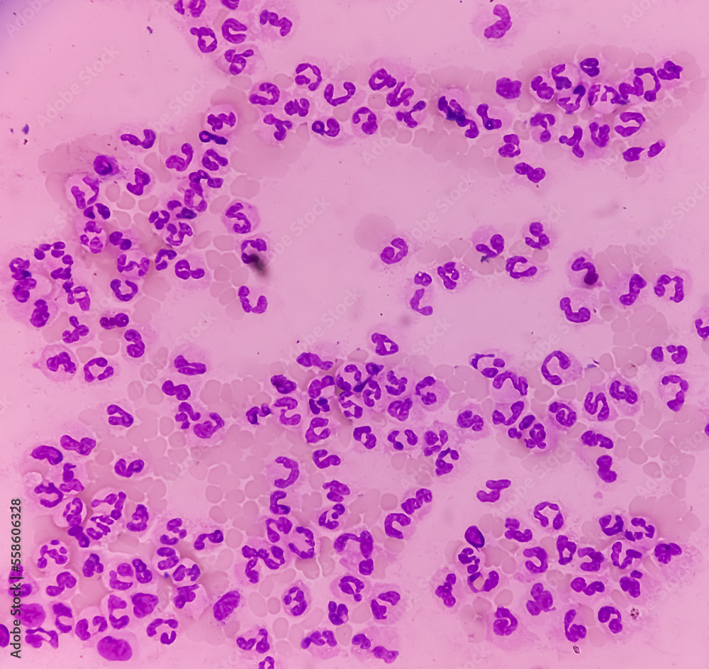 Microscopic finding, Neutrophilic leukocytosis with thrombocytosis ...