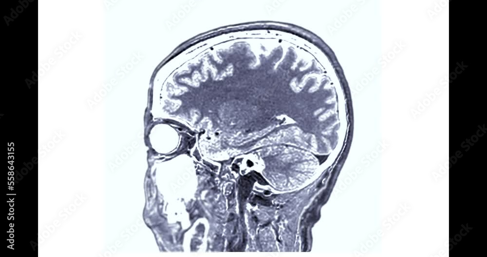 MRI Brain Sagittal T1W can help doctors look for conditions such as ...
