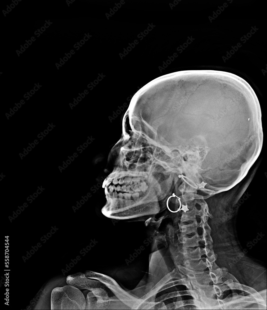 X-ray of neck and cervical spine side view. Image of radiography from ...