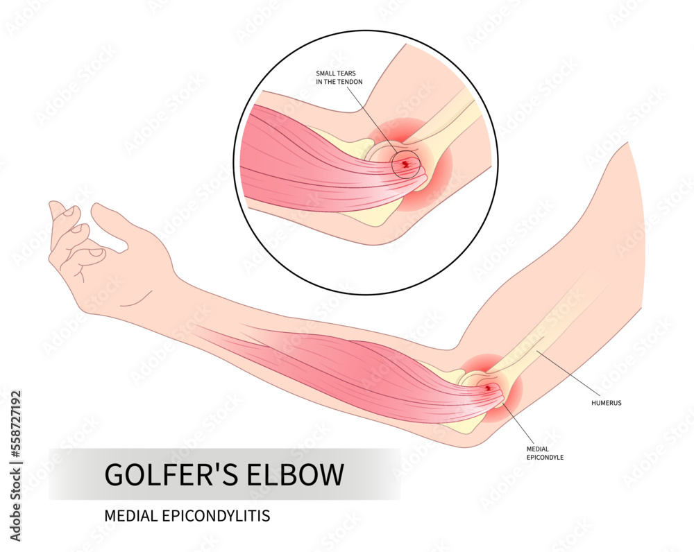 Golfer's elbow pain sport injury in pronation wrist common radial flexion rotator cuff of Cozen ...
