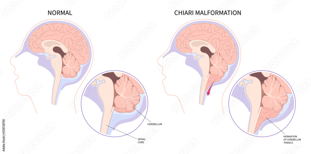 Arnold Chiari Malformation Diagram