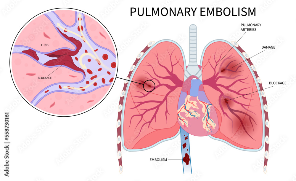 Lung blood clot chronic cough chest pain of leg thrombus air stroke ...