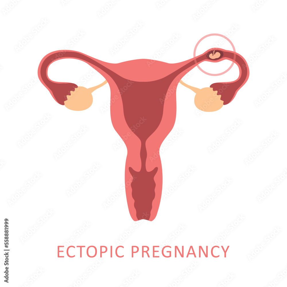 ectopic pregnancy female reproductive system women uterus Stock Vector ...