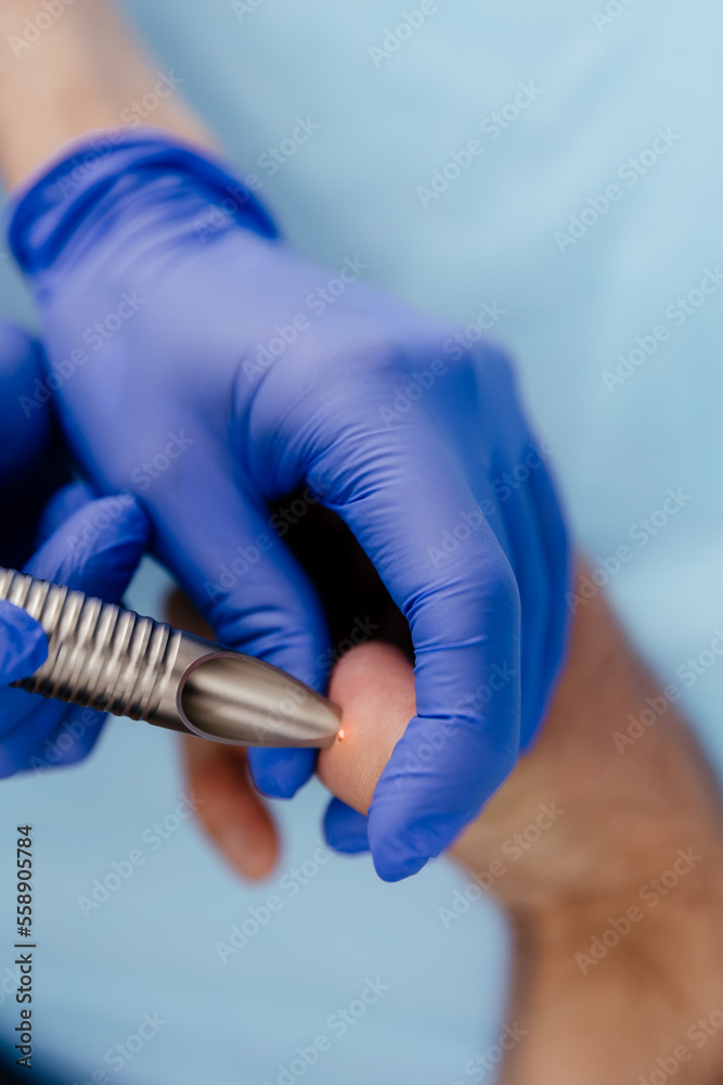 The doctor removes moles and warts with a laser beam. Mole removal ...