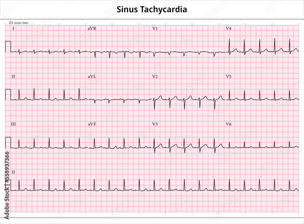 ECG Sinus Tachycardia - 12 Leads ECG Paper - Vector - Medical ...