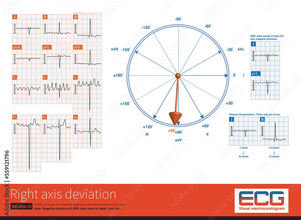 Long term mitral stenosis leads to pulmonary hypertension, which ...