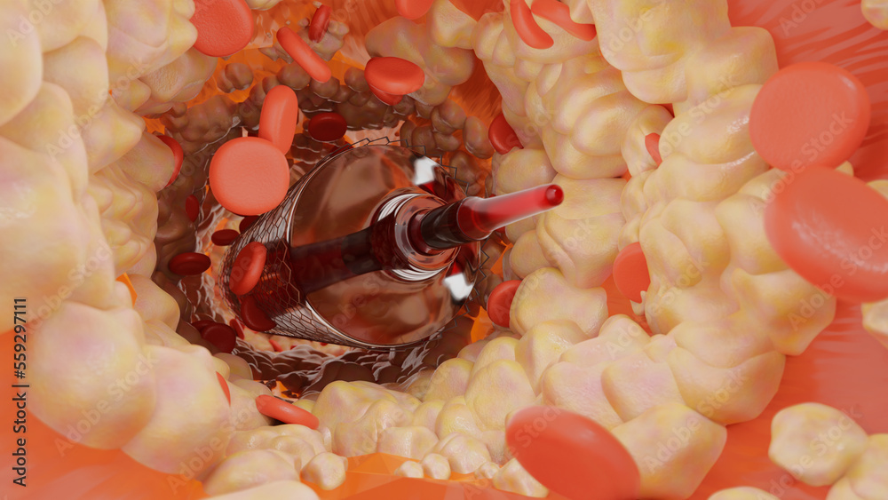 Stent in atherosclerosis with hyperlipidemia and red blood cell flow ...