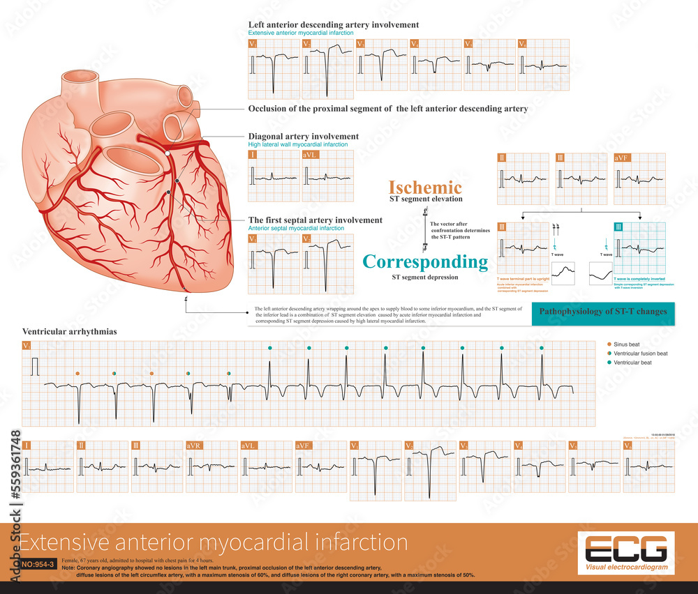 The proximal occlusion of the left anterior descending artery leads to a large area of anterior ...