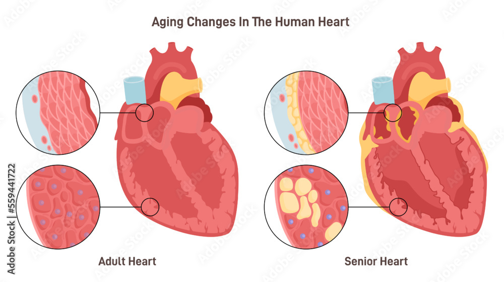 Aging changes in the human heart. Adult and senior heart comparing ...