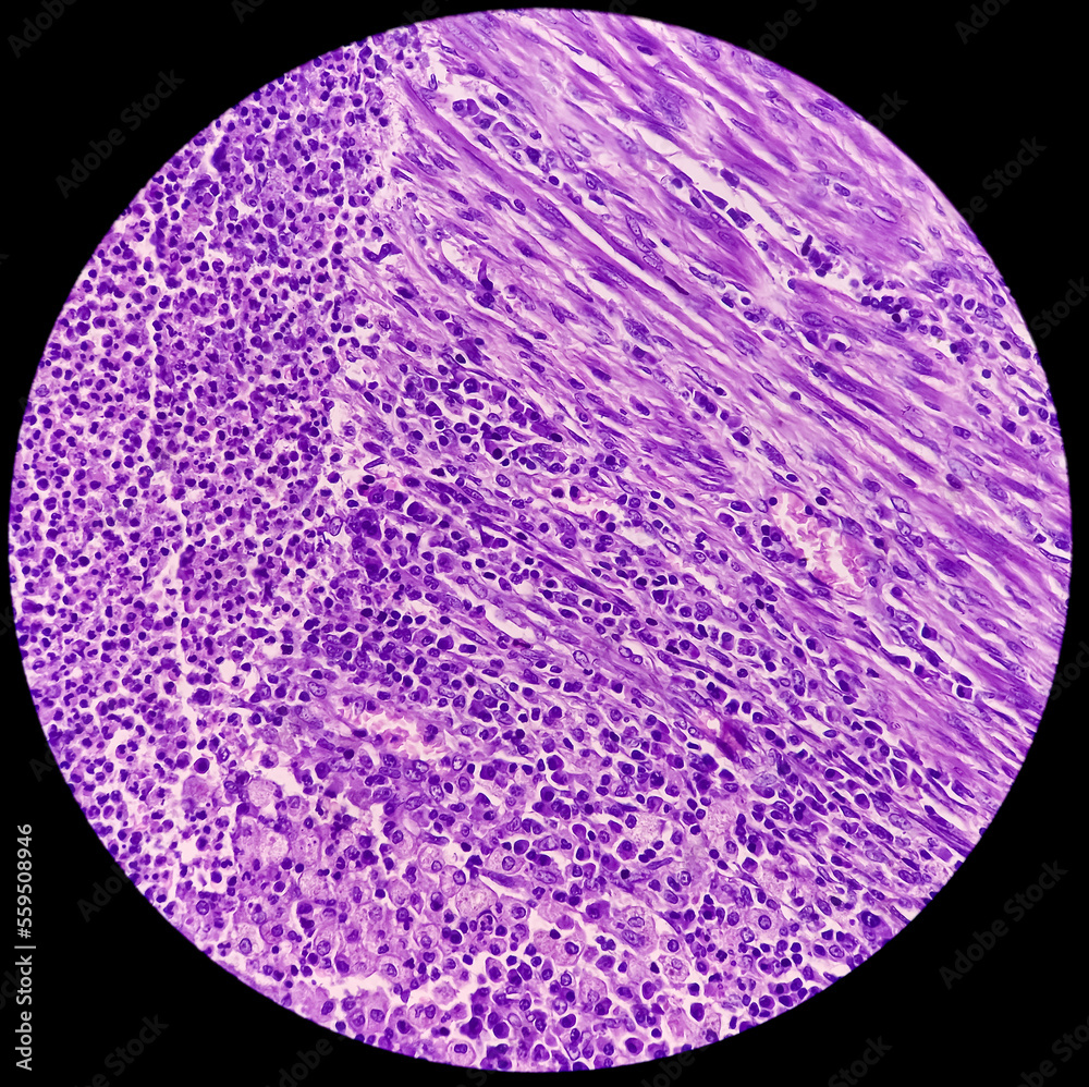Uterus wall consist pyometra with cervicitis, photomicrograph show ...