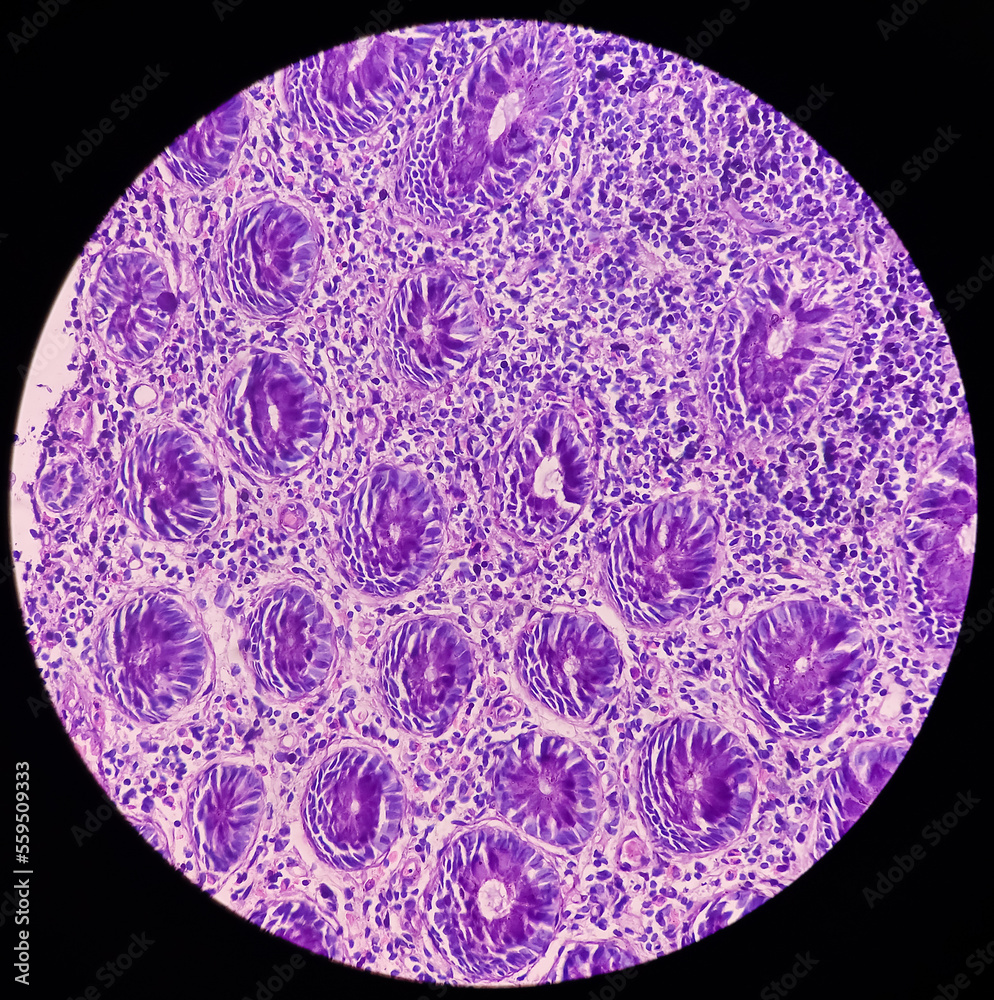 Transverse colon microscopic image seen atypical cell, colonic mucosa ...