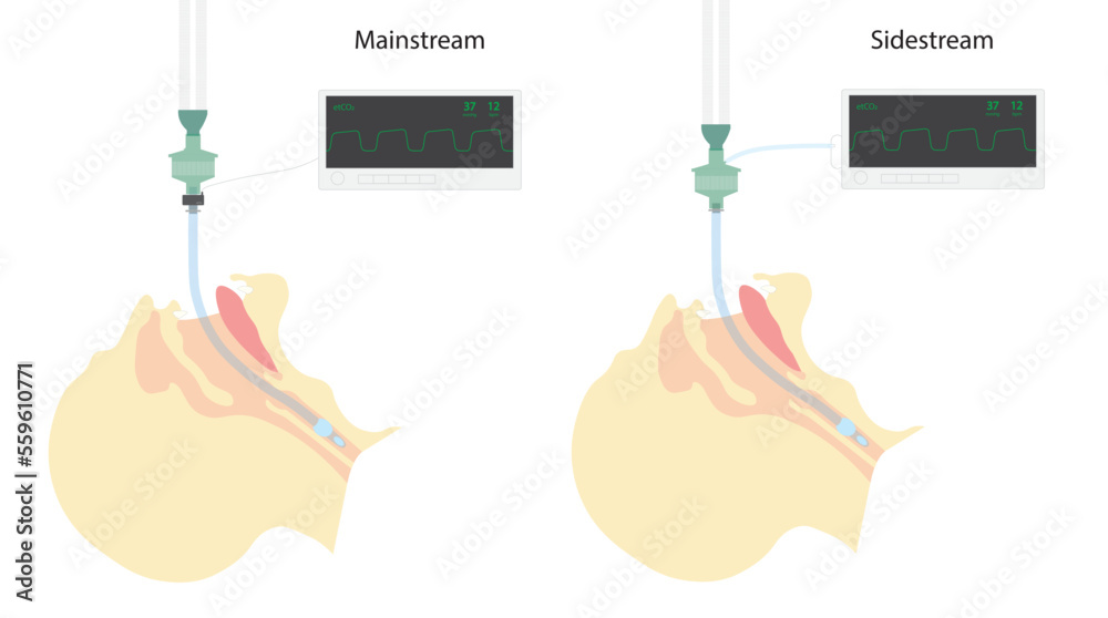 Different types of capnography measurement. Mainstream versus ...