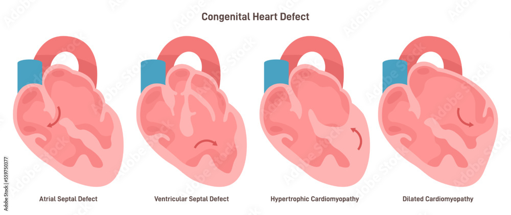 Congenital diseases of the heart set. Ventricular and atrial septal ...