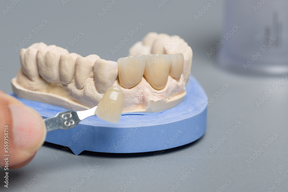 Dental imprint with artificial dentition and shade guide to check ... Dental imprint with artificial dentition and shade guide to check ...