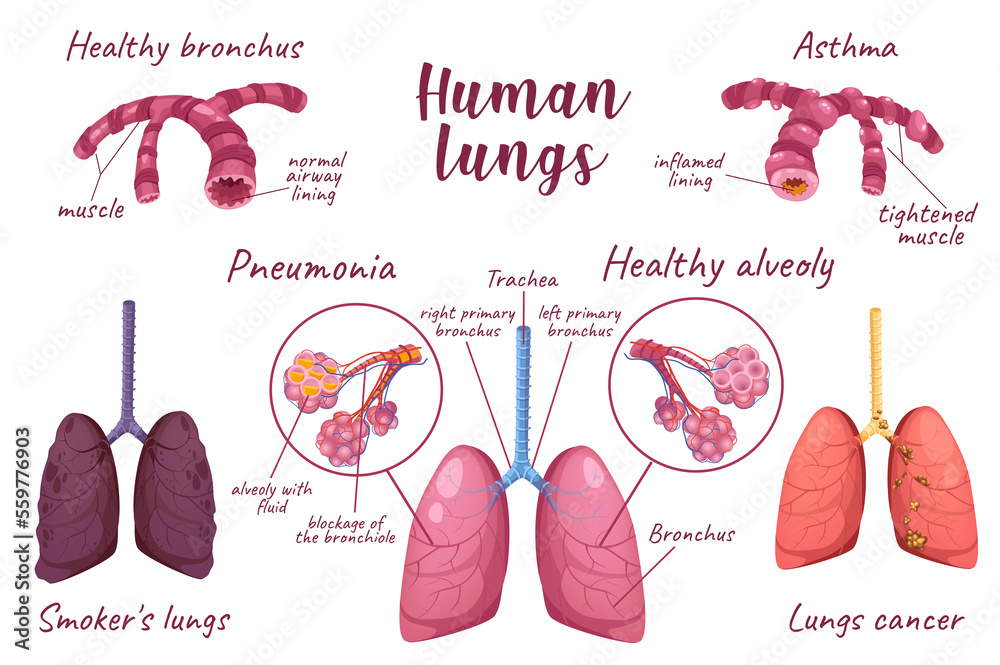 Human lungs 3d realistic set. Bundle of anatomy medical infographic for ...