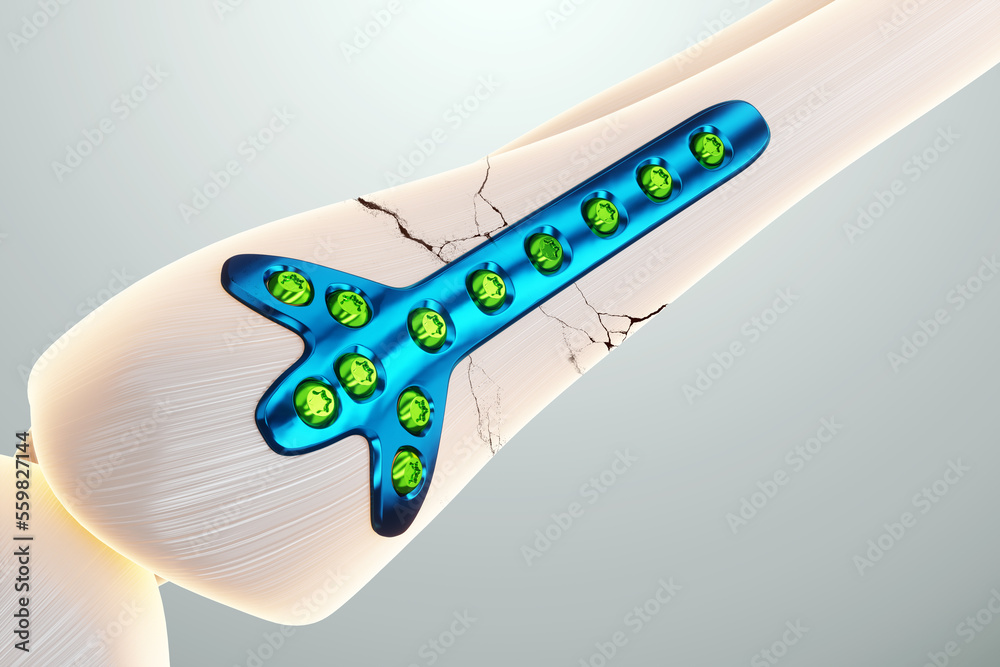 Medical procedure, osteosynthesis operation, surgical repositioning of ...