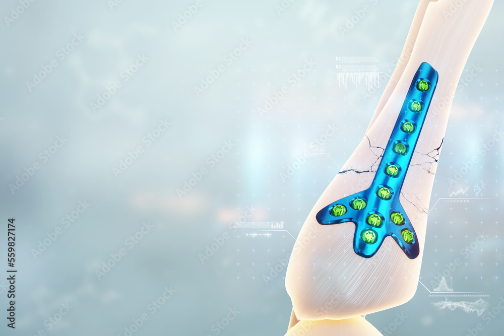 Medical procedure, osteosynthesis operation, surgical repositioning of ...