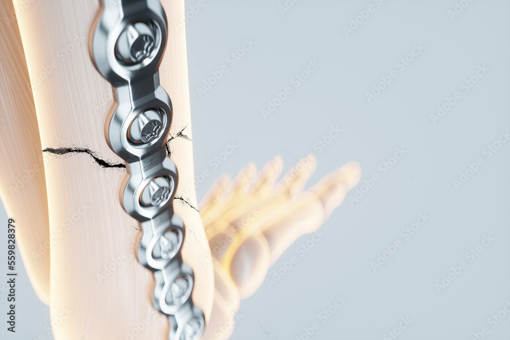 Medical procedure, osteosynthesis operation, surgical repositioning of ...