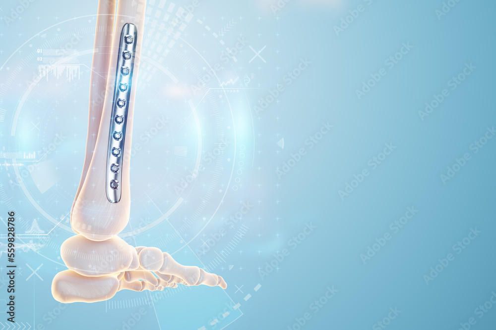 Medical procedure, osteosynthesis operation, surgical repositioning of ...