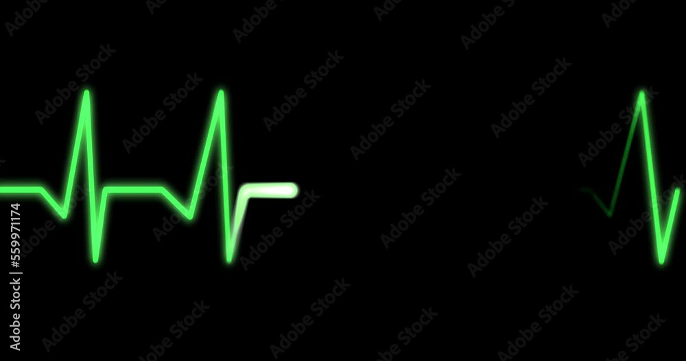 An electrocardiogram, ECG or EKG, that records the electrical signal ...