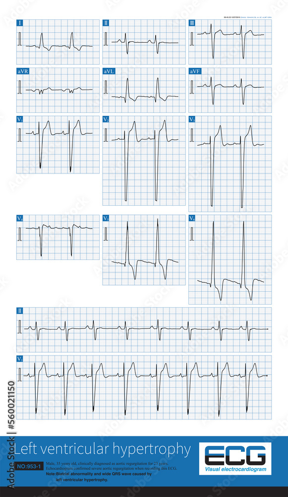 When aortic valve regurgitation occurs, in diastole, blood returns from ...