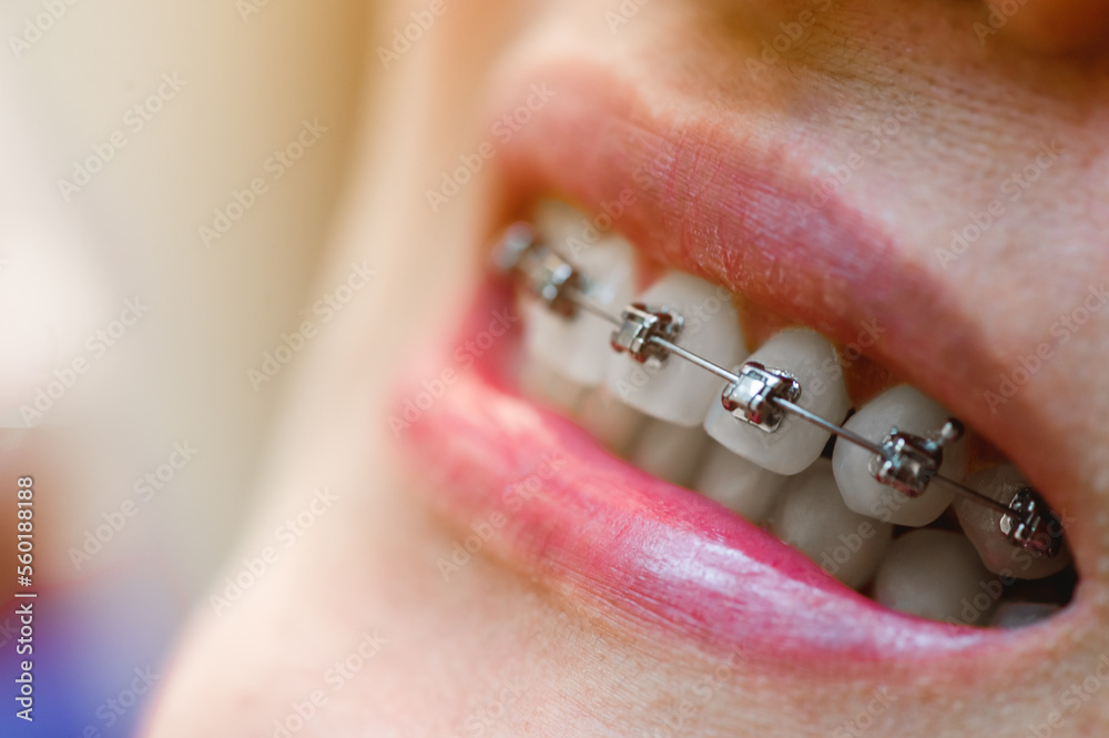 Foto de Dental braces in happy womans mouths on brackets on the teeth ...