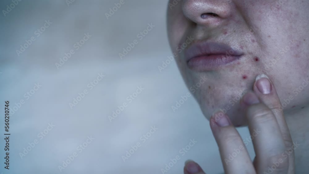 Close up of skin problems, unhealthy skin with acne and pimples. Porous ...