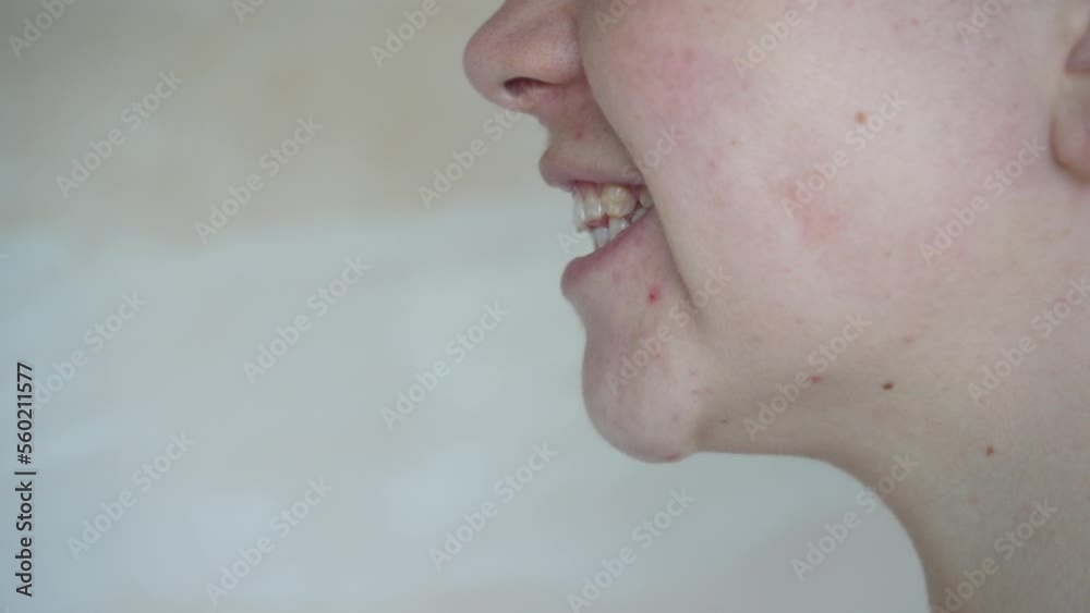 The Girl Smiles Showing A White Spot On The Tooth Fluorosis In The 0367
