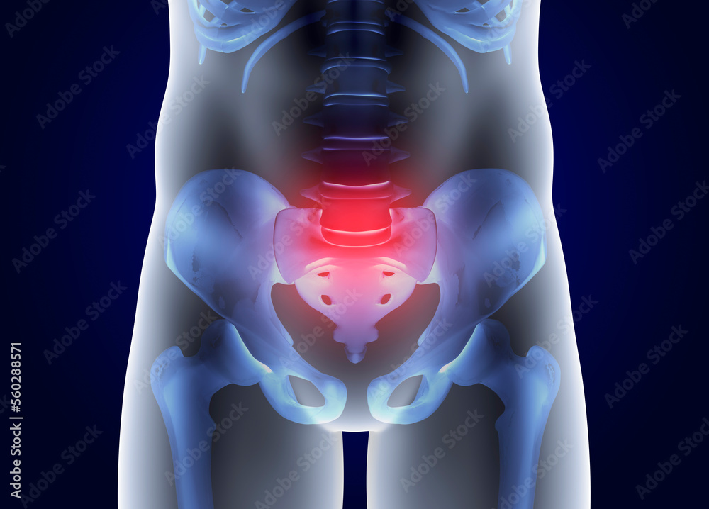 Sacrum pain, x-ray human anatomy, pelvic bone disease, sacrolitis, arthritis. Inflammation in ...