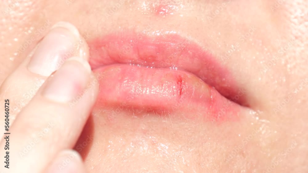 A woman touches her lips with her fingers with irritation cracks on the ...