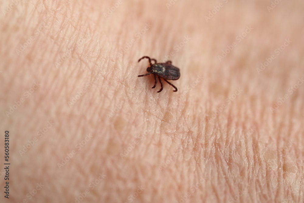 mite,Ixodid, encephalitic live tick on the human body close-up, macro ...