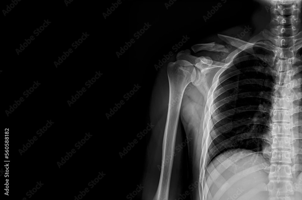 Plain radiograph of human shoulder after accident.The film shown ...