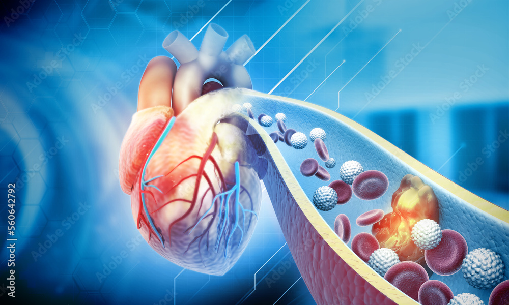 Cholesterol blocked artery with heart. A blood clot in the vessels of ...