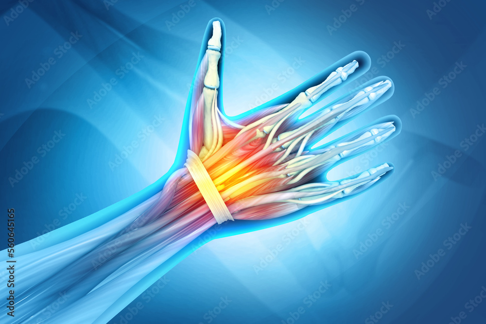 Wrist bones injury, wrist pain, x-ray view. 3d illustration Stock ...