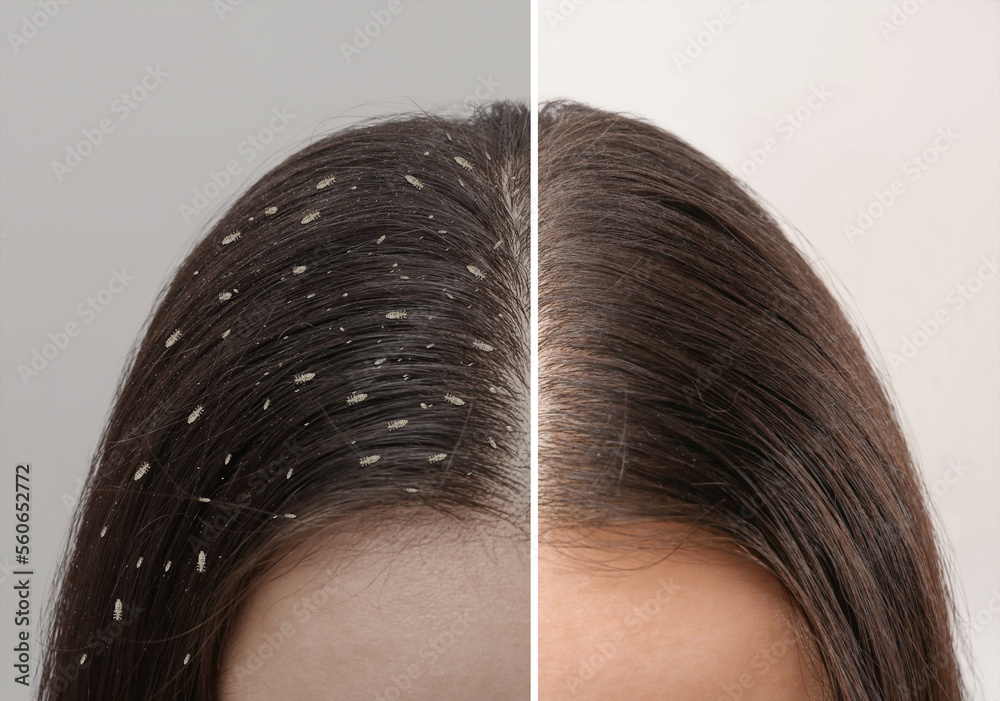 Collage showing woman's hair before and after lice treatment on light ...