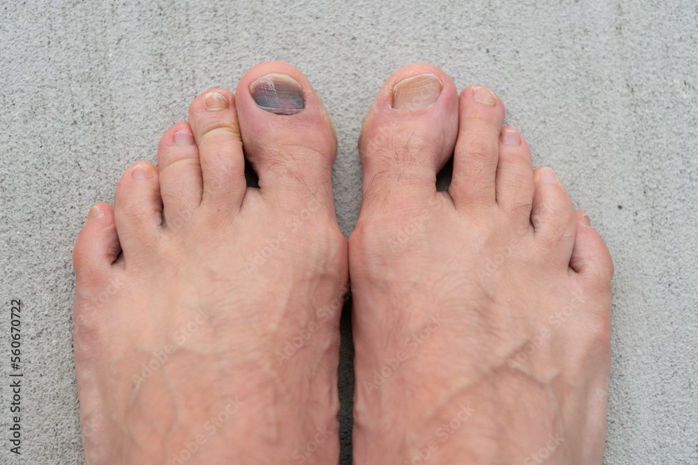 subungal toe nail bruise hemtoma. closeup of toe nail bruise hemtoma ...