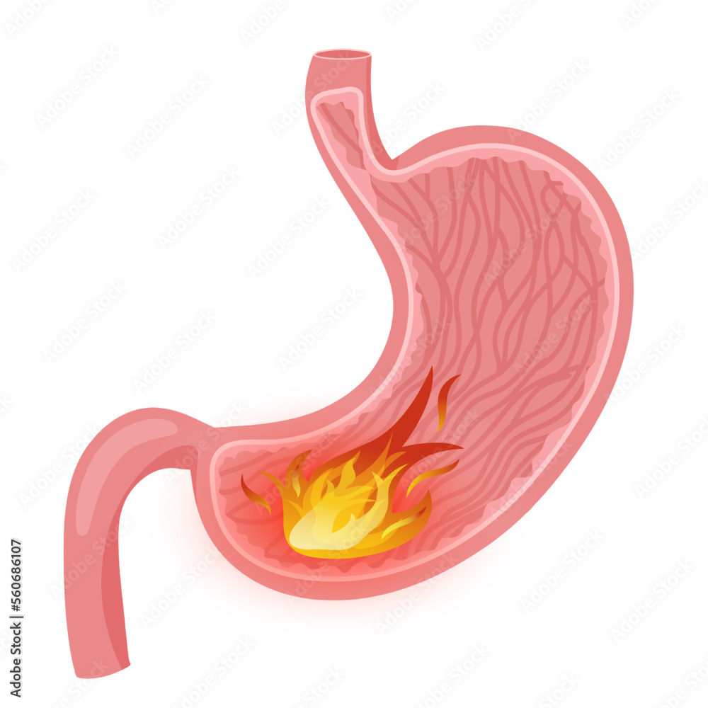 Stomach fire. Vector illustration, cartoon style, white background ...