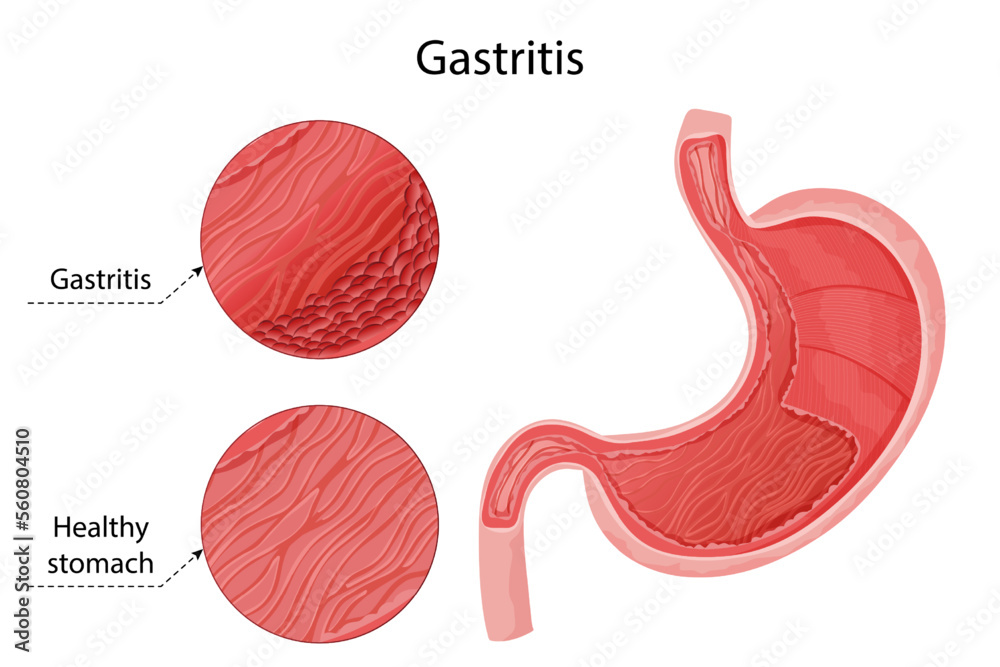 Gastritis detailed infographic in comparison with healthy stomach. Vector illustration, cartoon ...