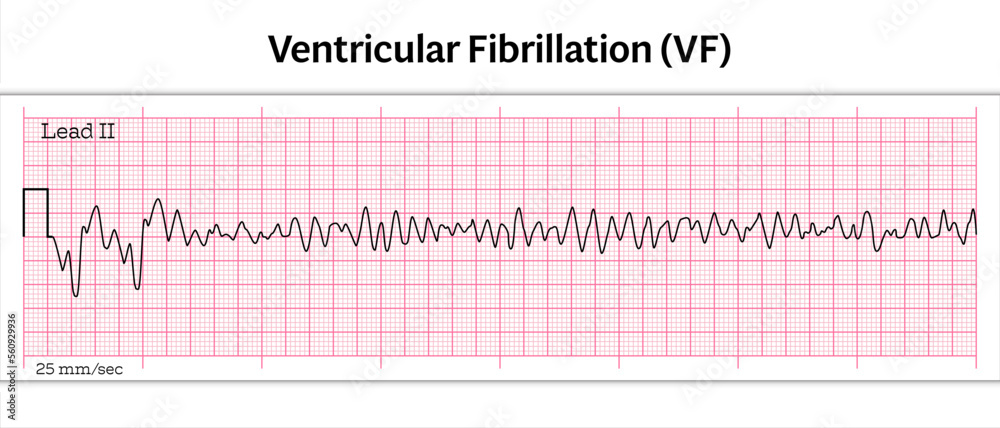 ECG Ventricular Fibrillation VF 8 Second ECG Paper Vector Medical