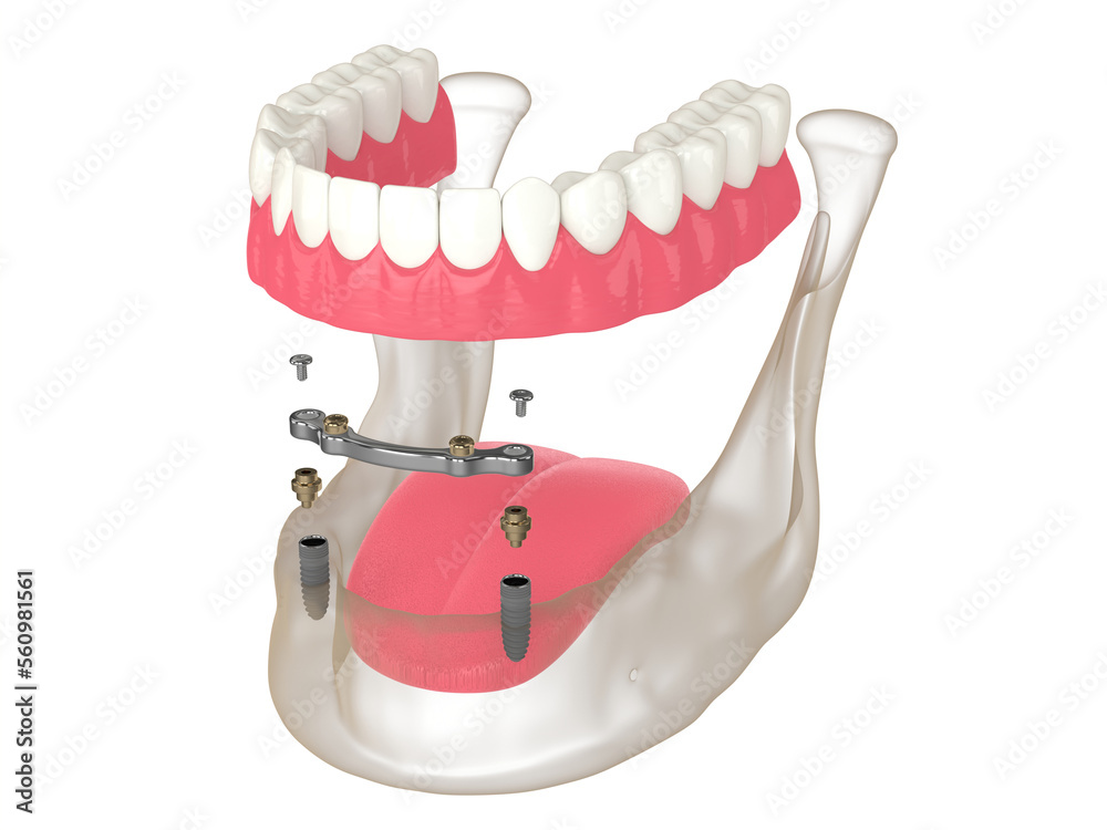 3d render of bar retained removable overdenture installation supported ...